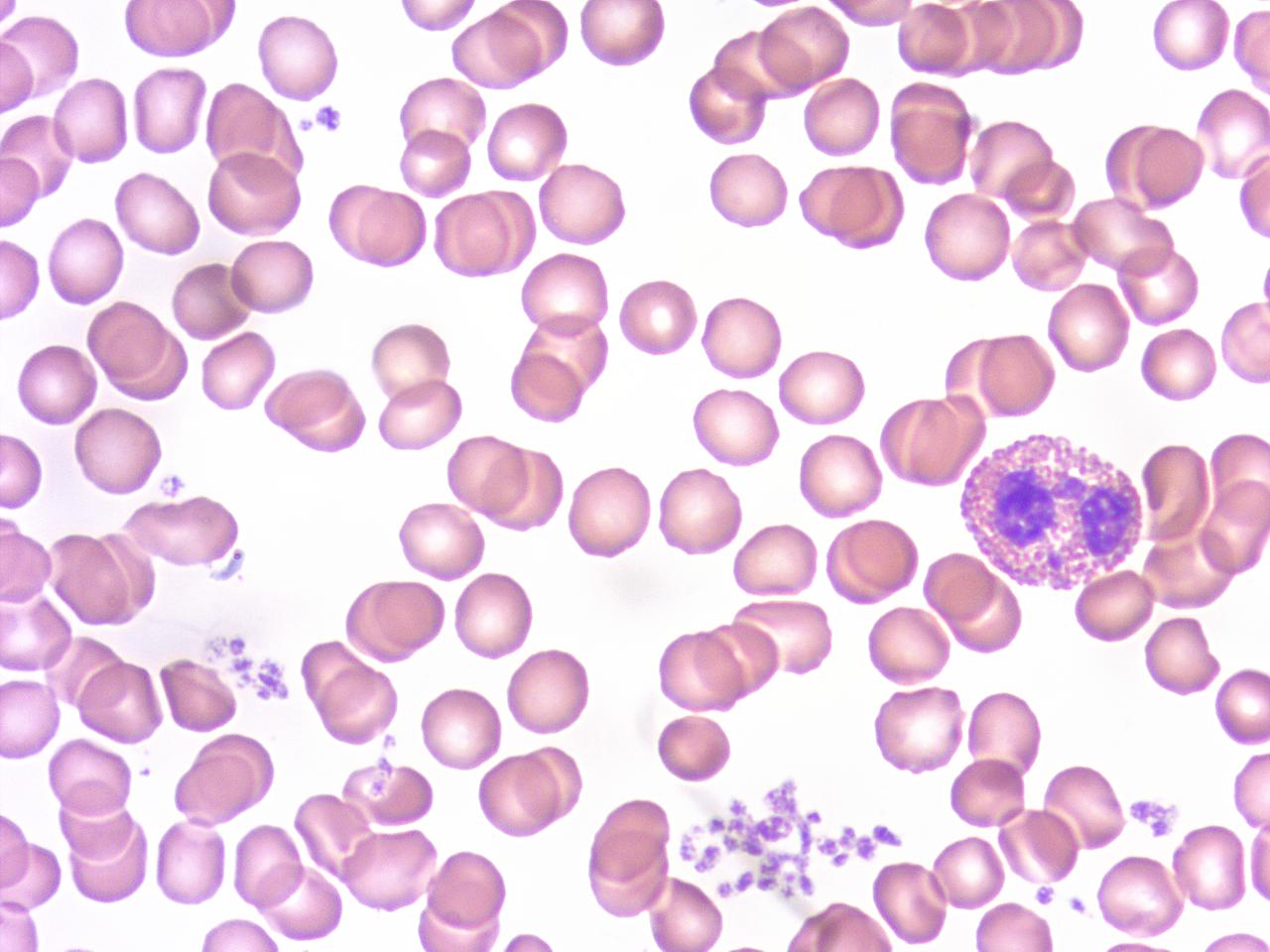 Hematology Clinical Bundle Download